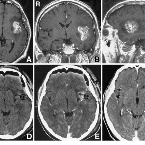 Pdf Awake Surgery For Glioma Resection In Eloquent Areas Zurichs