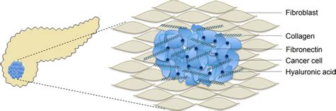 Schematic Figure Of The Desmoplastic Stromal Reaction In Pdac Involving