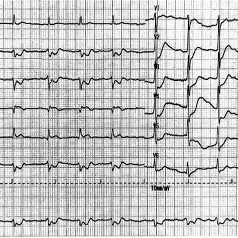 Ecg Performed After The First Defibrillation Download Scientific Diagram