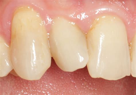 How To Bulk Fill Flowable Composite Restorations Without A Capping Layer