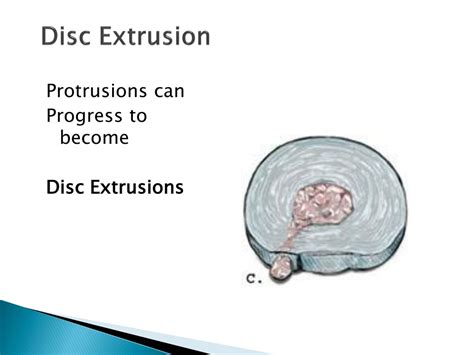 Ppt Understanding Lumbar Spine Anatomy 101 Realities Disorders