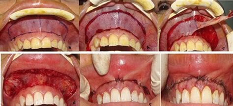 Cephalometric Analysis To Determine Skeletal Classification Download Scientific Diagram