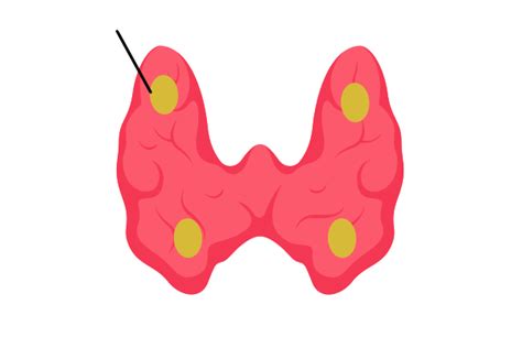 Parathyroid Blank Patient Education Endocrine Diseases Aaes