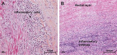 Examples Of Inflammation In Systemic Arteritis A Representative