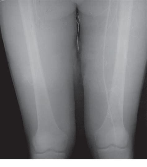 Figure 1 From The Use Of A Temporary Intraluminal Shunt To Restore Lower Limb Perfusion Over A