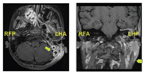 Mastoiditis Mri