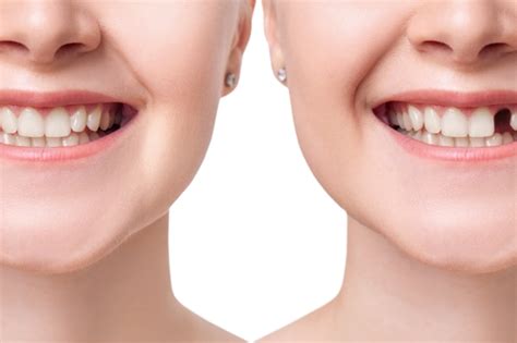 Tooth Replacement Oris Dental Richmond Hill Ontario