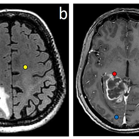 Segmentation Of Rois On Mri Of A Glioblastoma Patient For Analysis Of