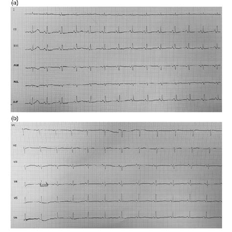 A ECG Showing Resolution Of T Wave Inversion In Limb Leads 2 Months Download Scientific