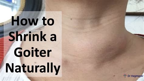 Thyroid Goiter Heres What Caused It And How To Stop It From Growing Dr Hagmeyer