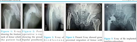 Figure 5 From Total Hip Arthroplasty In A Girdlestone Hip Following A Failed Hemiarthroplasty