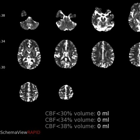 Ct Perfusion Demonstrating Normal Cbf Cbfcerebral Blood Flow