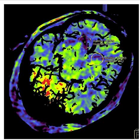 Flat Panel Ct Perfusion Cbv Showed No Perfusion Differences Between Download Scientific