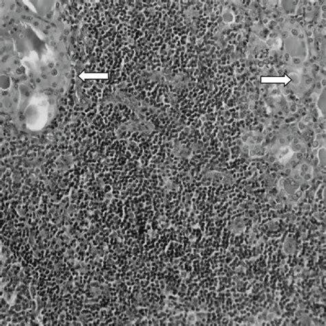 Close Up View Of The Non Tumoral Thyroid Parenchyma Showing Germinal Download Scientific