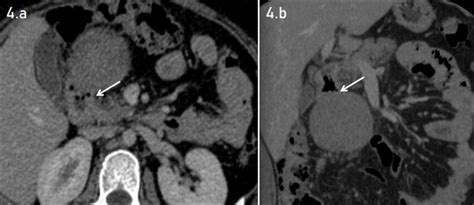 A And B 63 Year Old Case With Malignant Gastric Gist Axial Views Of