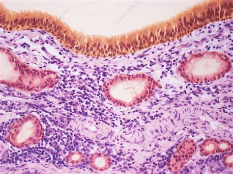 Sinusitis Light Micrograph Stock Image C021 1144 Science Photo Library