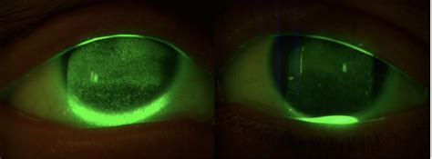 Severe Dry Eye In Cd25 Deficiency Syndrome