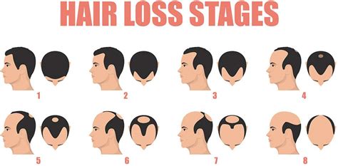Stages Of Male Pattern Baldness Infographic