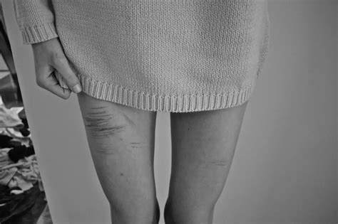 Tumblr Cutting Scars