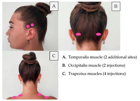 Botulinum Toxin In Chronic Migraine Treatment Encyclopedia Mdpi