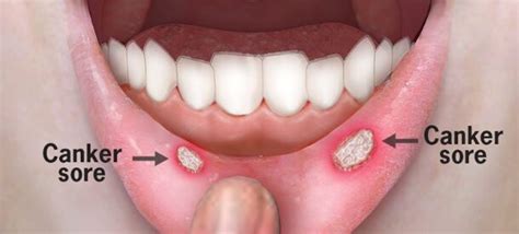 What Causes Red Dots On Mouth