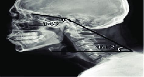 Craniovertebral Angle Cranial Rotation Angle Download Scientific