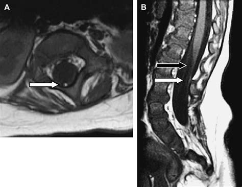 Tethered Cord Syndrome Neurosurgery Clinics