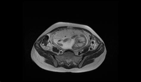 Fetal Brain Mri Axial Large Fov Images Mrimaster