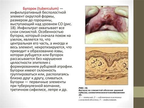 Элементы поражения слизистой оболочки полости рта Первичные элементы поражения Online
