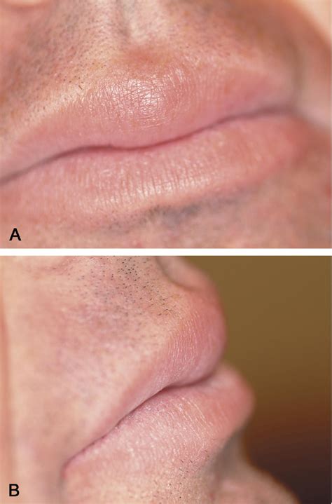 A Diffuse But Subtle Swelling Of The Upper Lip Oral Surgery Oral