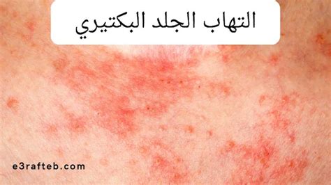 الجلد والصحة كيف تتجنب الإصابة بالالتهاب الجلدي البكتيري؟