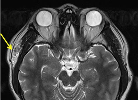 Scalp Arteriovenous Malformation Mistaken For A Hemangioma Radiology Cases