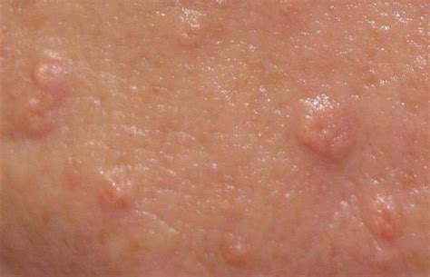 Sebaceous Hyperplasia Treatment At Home Sebaceous Hyperplasia