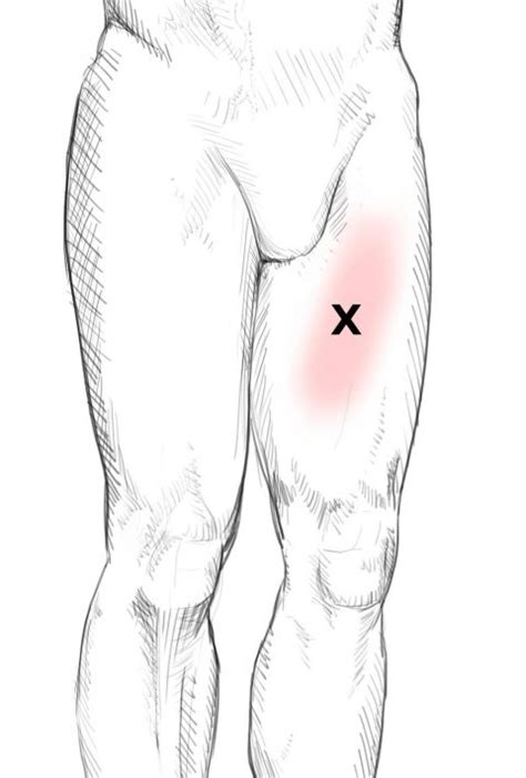Sartorius Trigger Points