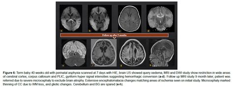 Journal Of Radiology Hypoxic Ischemic Encephalopathy Mri Findings And