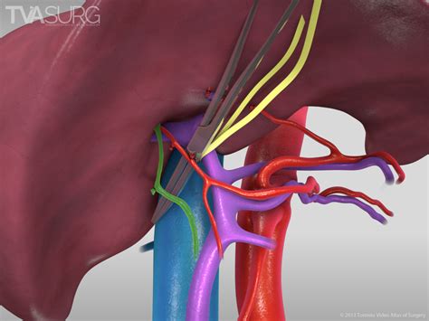 Extended Left Hepatectomy Pkvisualization Surgery