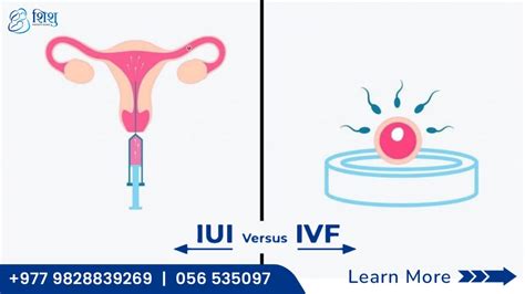 IUI treatment in Nepal - Sishu Fertility Clinic & IVF Center
