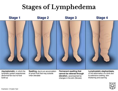 Lymphedema Treatment