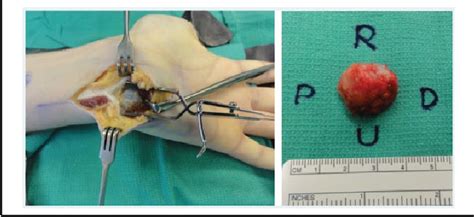 Figure 3 From Aneurysmal Bone Cyst Involving The Pisiform A Case Report Semantic Scholar