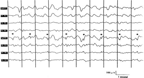 The Eeg In Coma Journal Of Clinical Neurophysiology