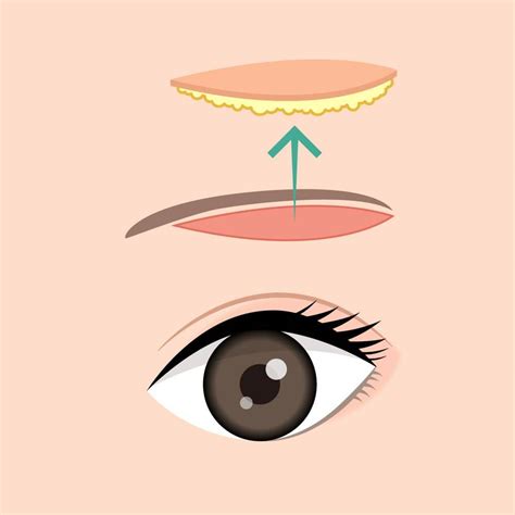 Drooping Eyebrow Surgery Fix The Saggy Eyebrows Trambellir