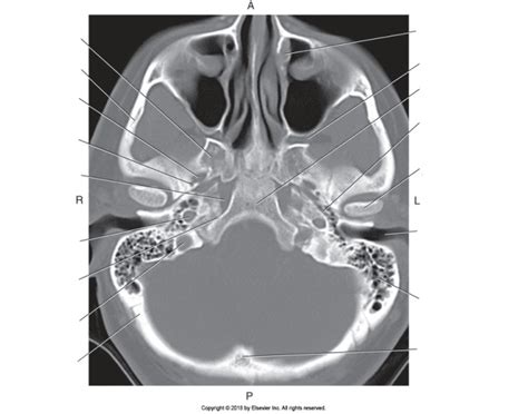 Axial Ct Of Temporal With Iac Quiz
