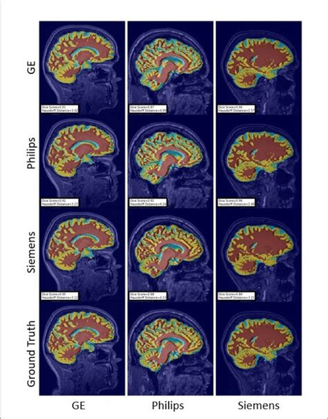 Figure Representative Sample Wm Gm Csf Segmentation Generated By The