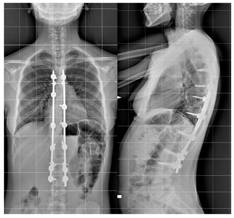 example of all pedicle screw construct for the treatment of ais ap