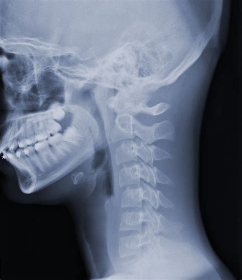 Anatomía De La Radiografía Lateral Del Cuello Cómo Leer Una