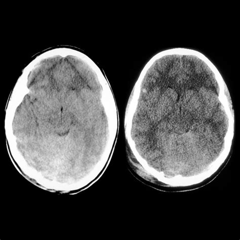 Diffuseaxonalinjury01tchdelayedearlylatehct13yo Pediatric Radiology