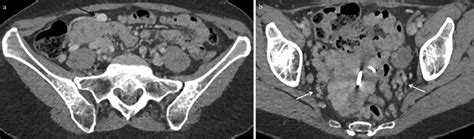 A B Portal Phase Contrast Enhanced Ct Showing Dilated Collateral Download Scientific