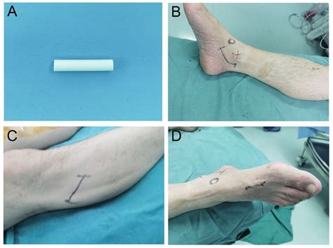 Improving Effects Of Peripheral Nerve Decompression Microsurgery Of Lower Limbs In Patients With