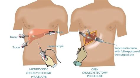 Laparoscopic Vs Open Surgery For Gallstones Which One Is Better