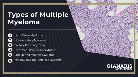 Occupational Diseases Multiple Myeloma Gianaris Trial Lawyers
